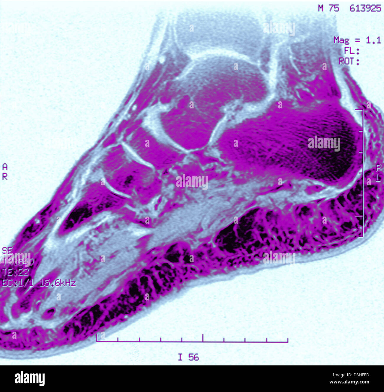 Foot mri scan hi-res stock photography and images - Alamy