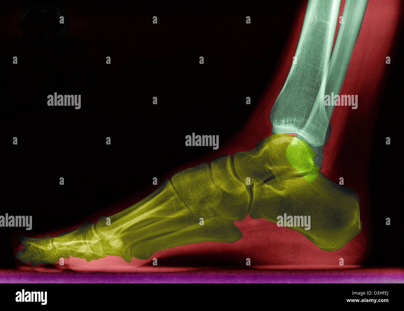 With and without heels feet x ray hi-res stock photography and images ...