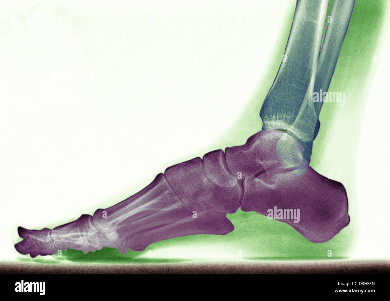 X ray normal foot hi-res stock photography and images - Alamy