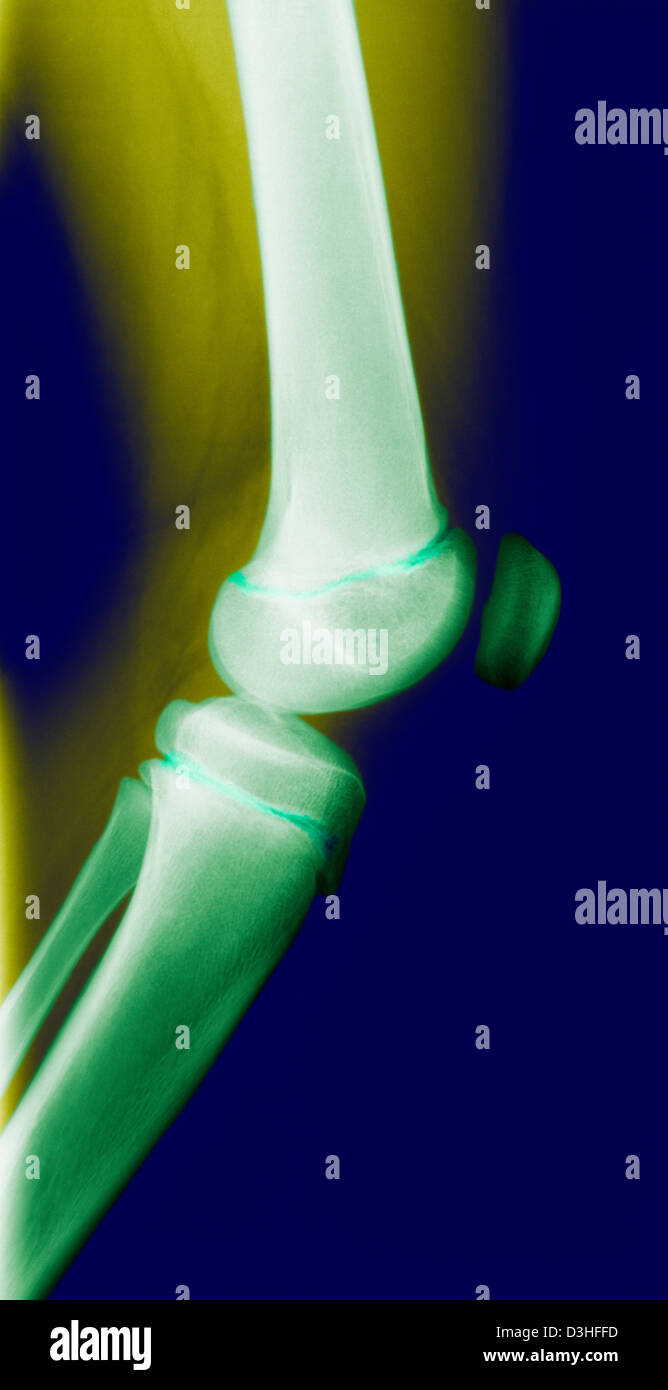 Normal child x ray hi-res stock photography and images - Alamy