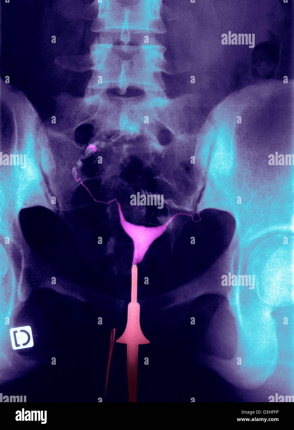 Hysterography hi-res stock photography and images - Alamy