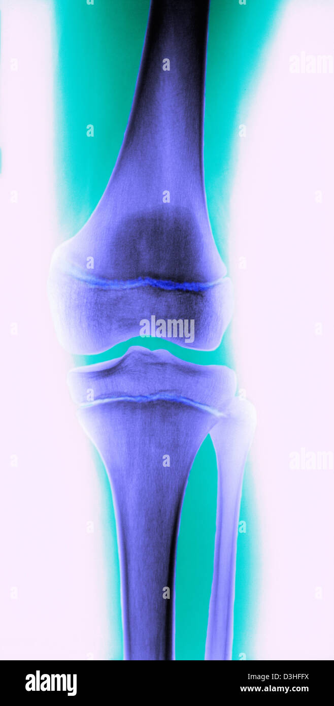 Normal knee x ray hi-res stock photography and images - Alamy