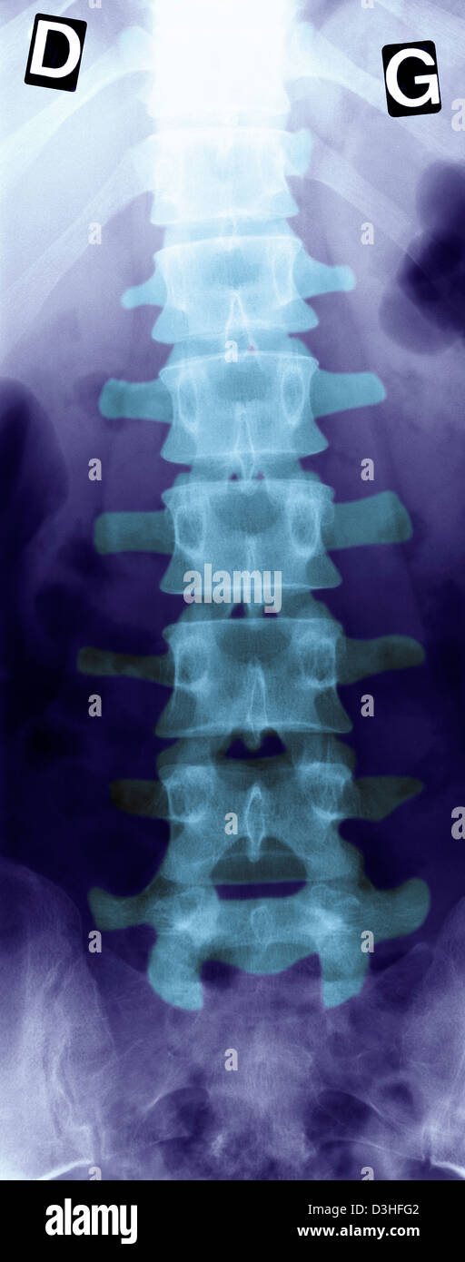SPINAL COLUMN, X-RAY Stock Photo - Alamy