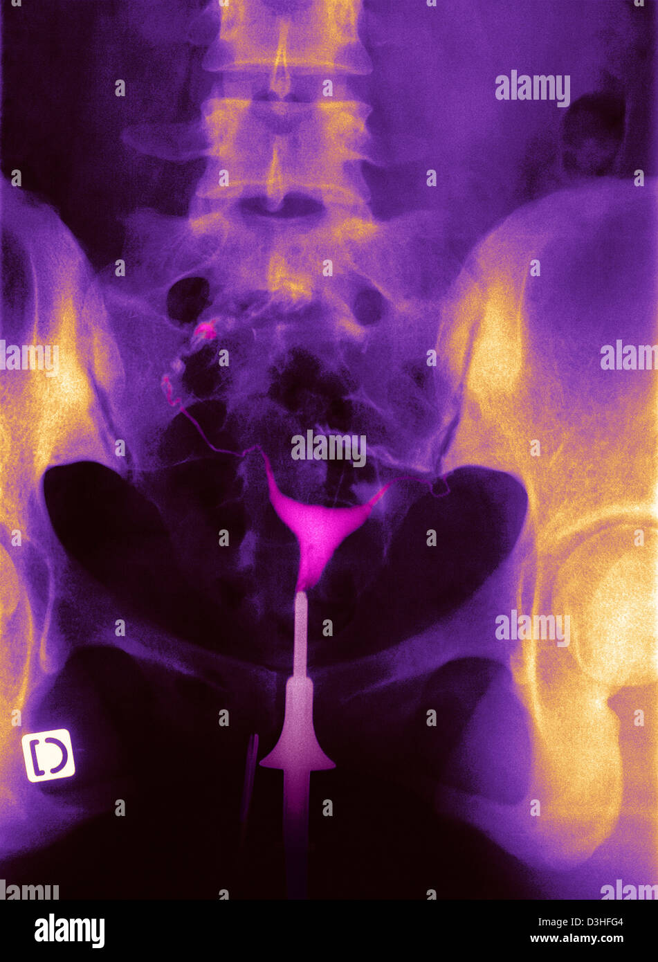 Hysterography hi-res stock photography and images - Alamy