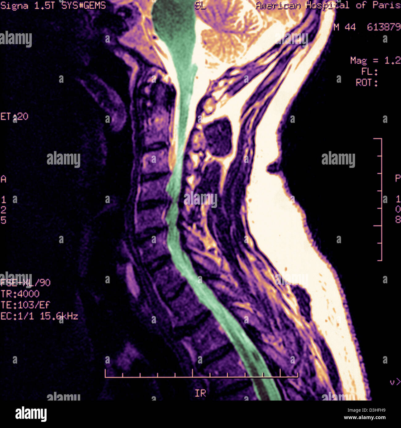 Cervical osteoarthritis, mri hi-res stock photography and images - Alamy
