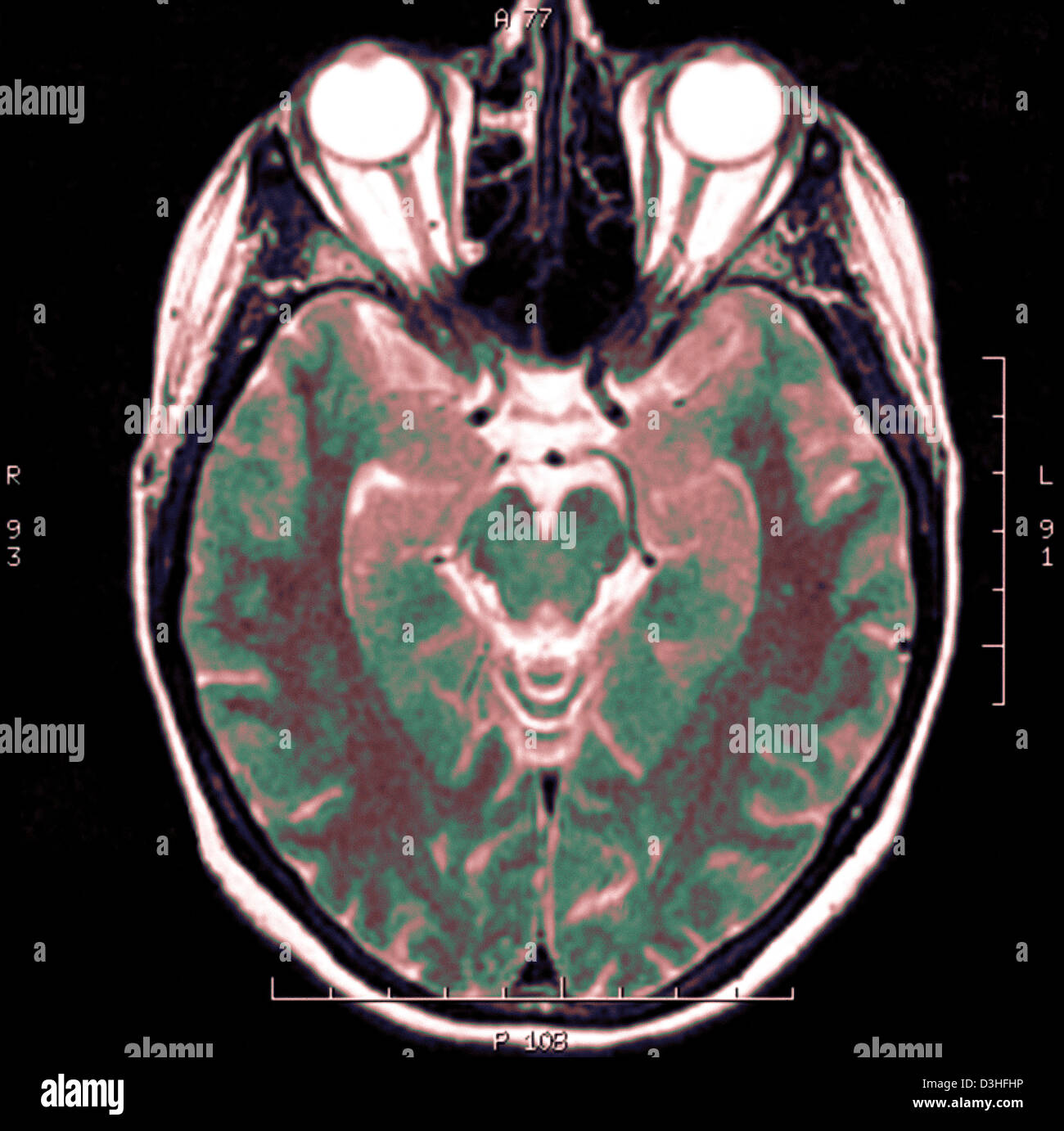 Normal brain scan hi-res stock photography and images - Alamy