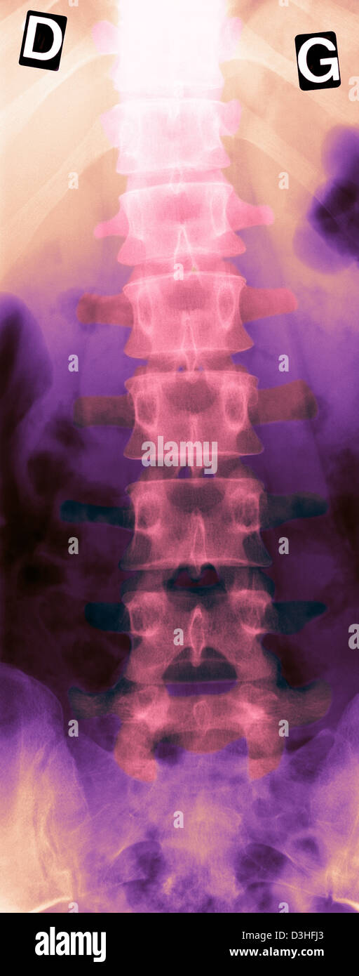 SPINAL COLUMN, X-RAY Stock Photo - Alamy
