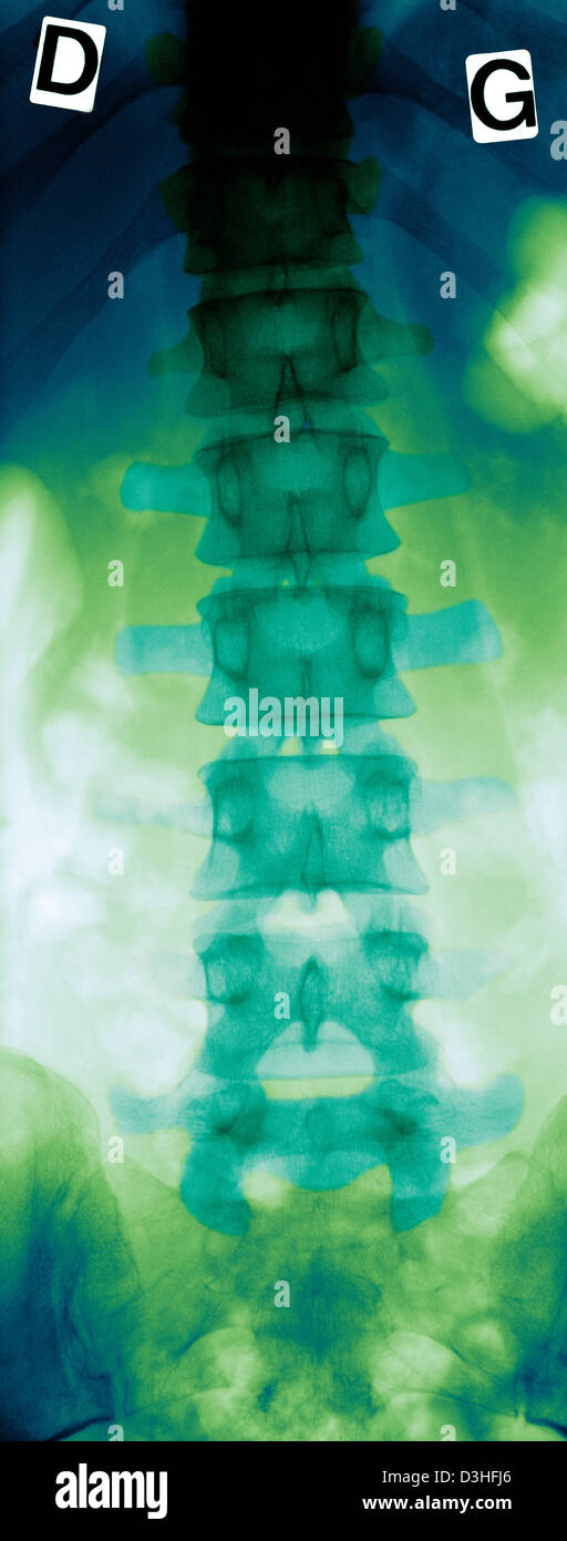 Backbone x ray normal hi-res stock photography and images - Alamy