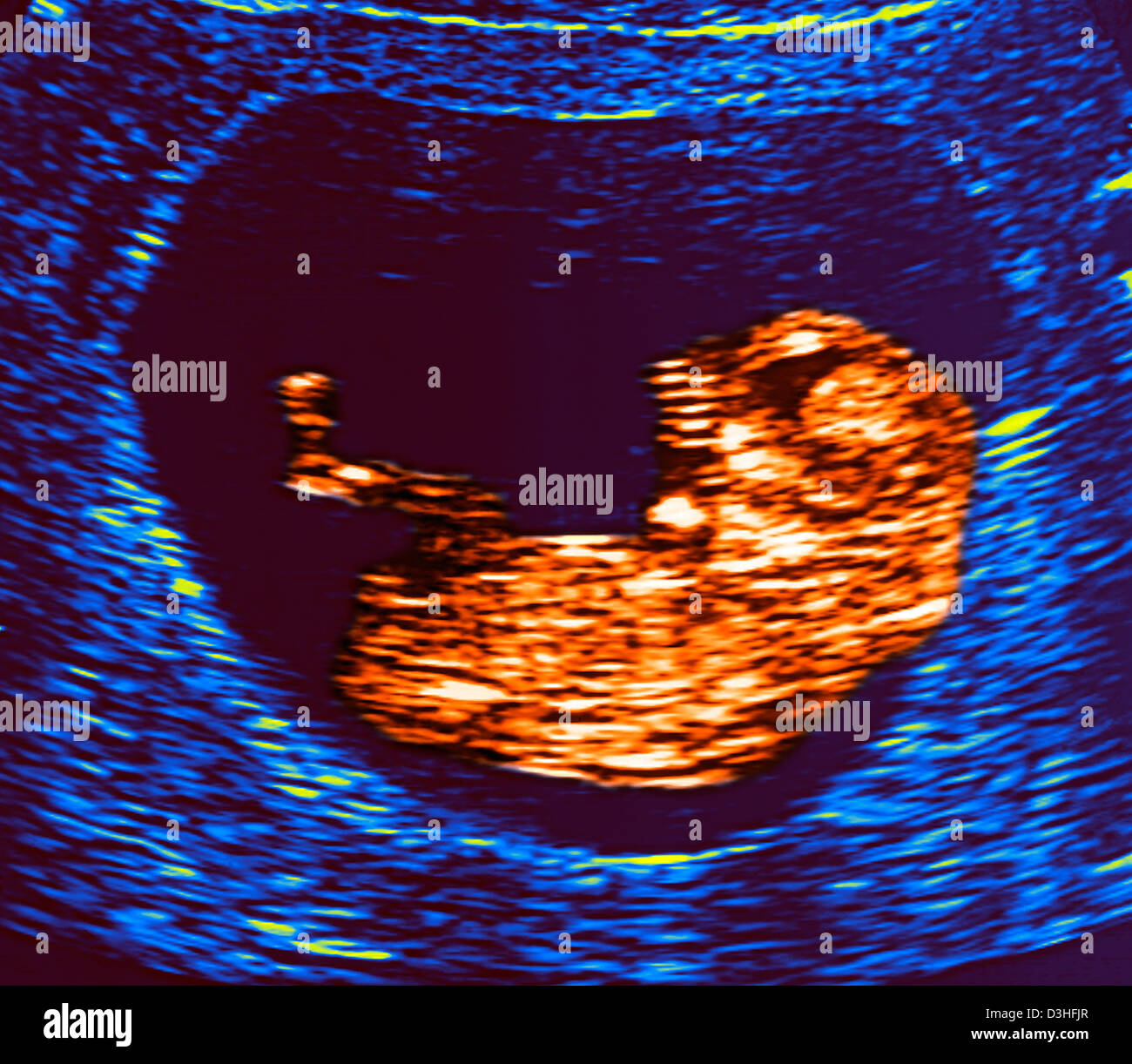 3 months fetus hi-res stock photography and images - Alamy