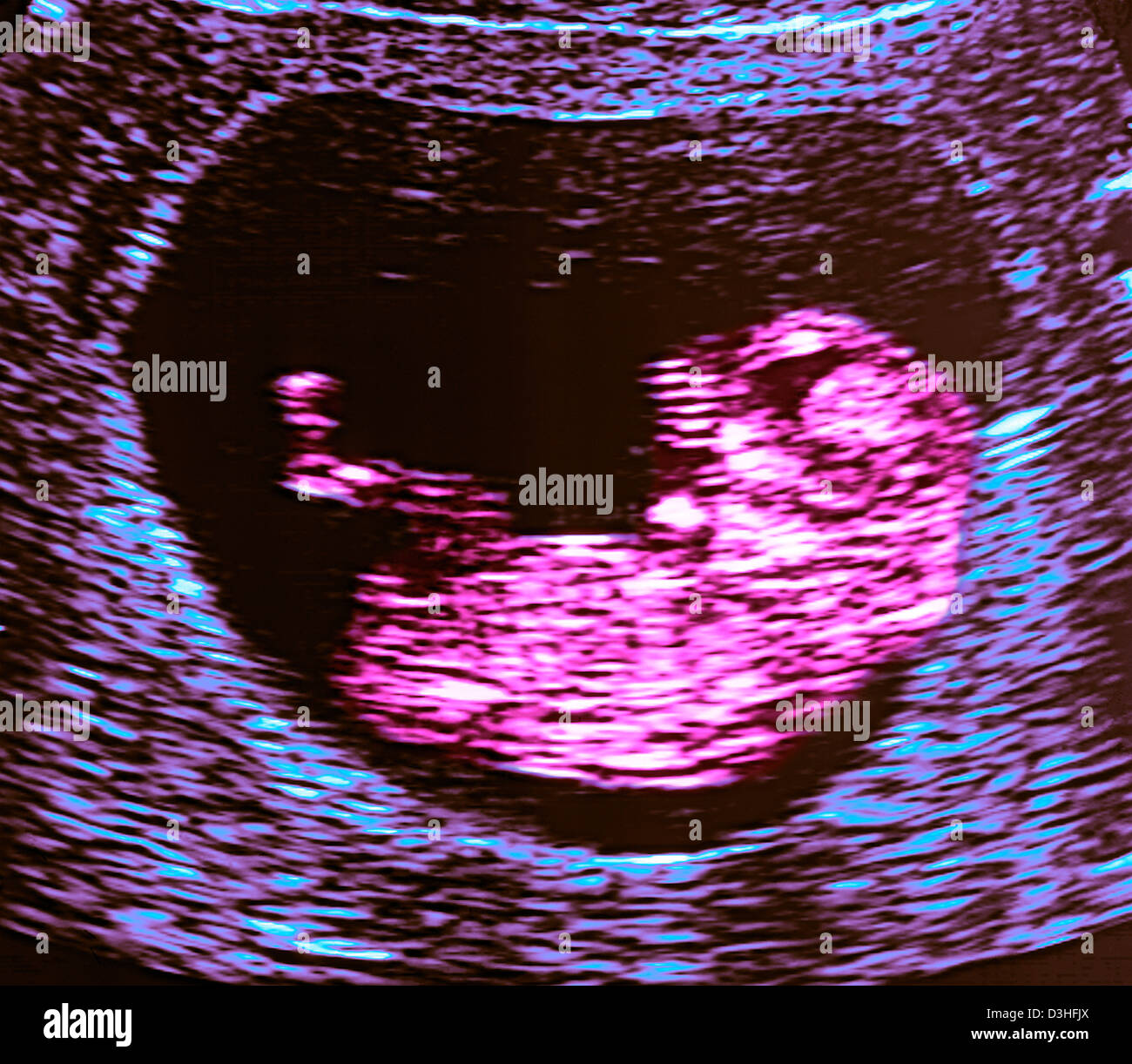 ULTRASOUND BIOMETRY OF THE FETUS Stock Photo - Alamy
