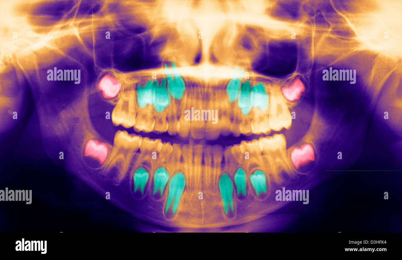 Normal child x ray hi-res stock photography and images - Alamy