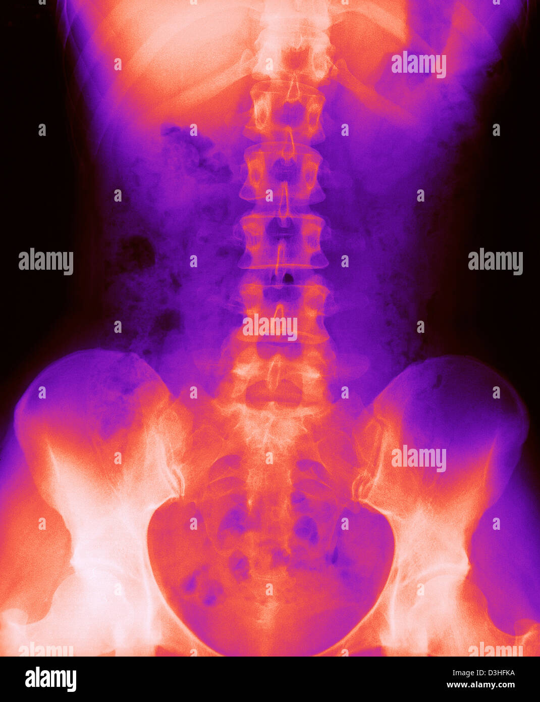 SPINAL COLUMN, X-RAY Stock Photo - Alamy