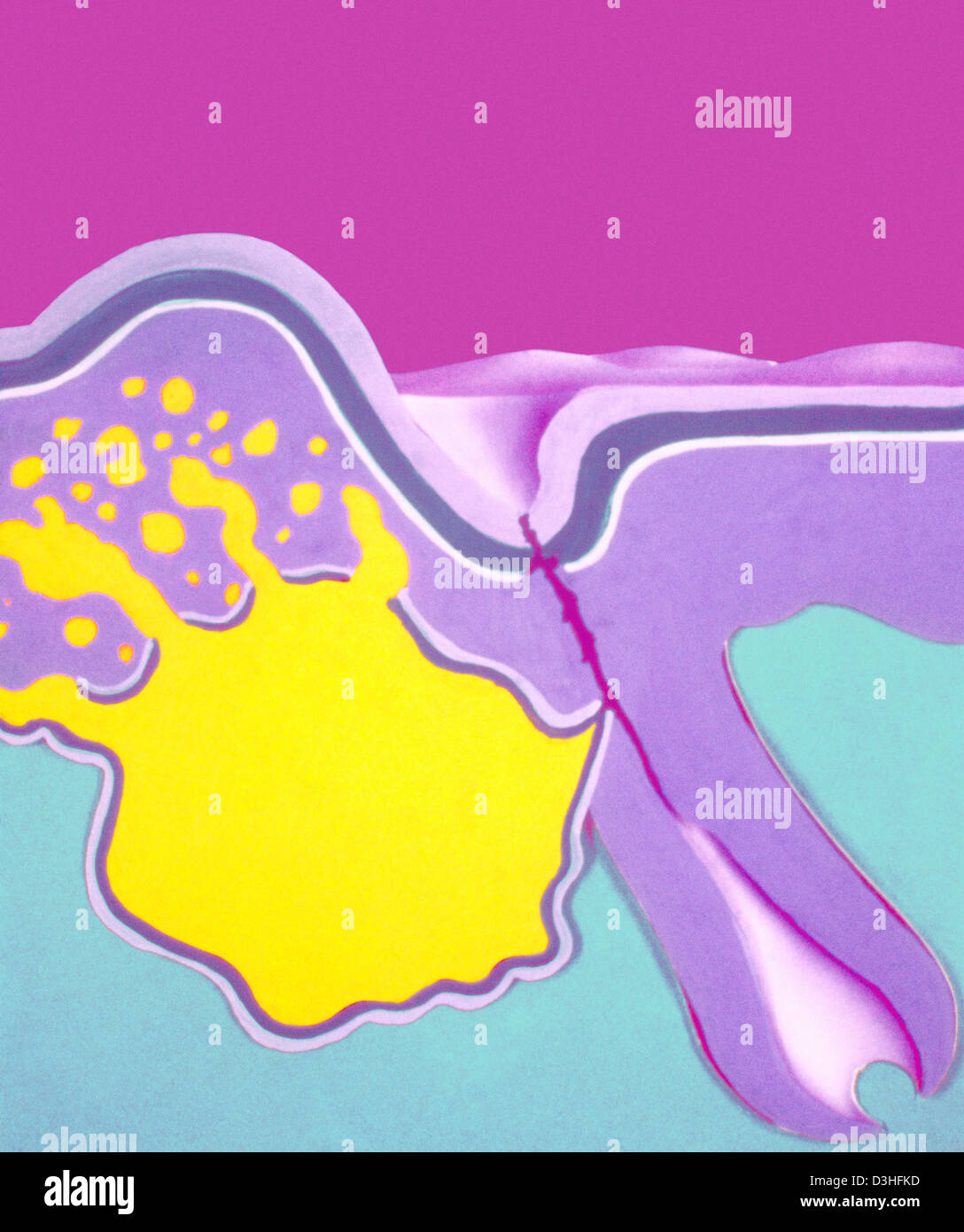 Acne drawing hi-res stock photography and images - Alamy