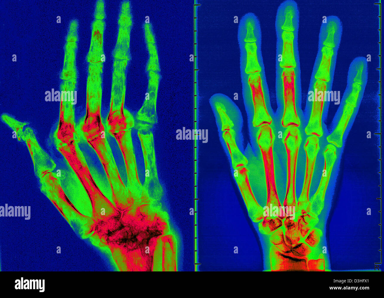 RHEUMATOID ARTHRITIS, X-RAY Stock Photo - Alamy