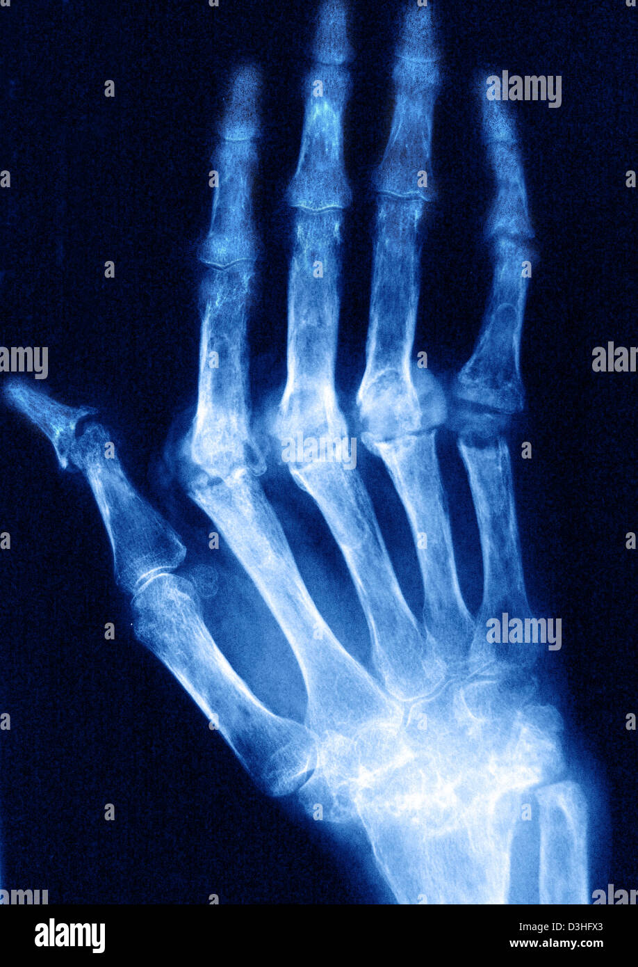 Rheumatoid arthritis hands x ray hi-res stock photography and images ...
