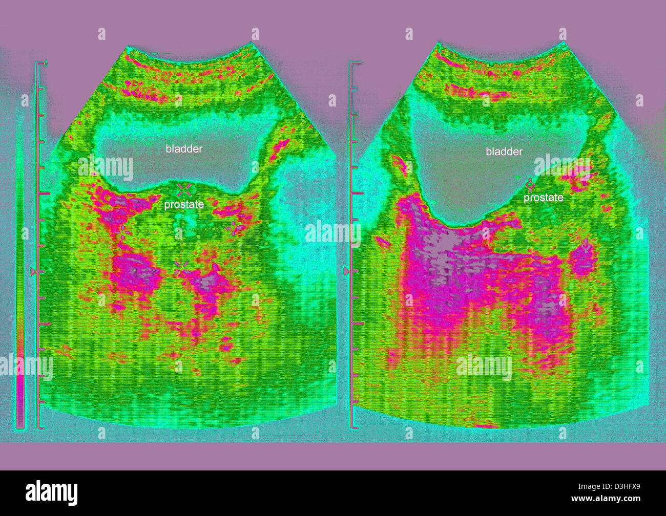 PROSTATE SONOGRAM RESULTS Stock Photo - Alamy
