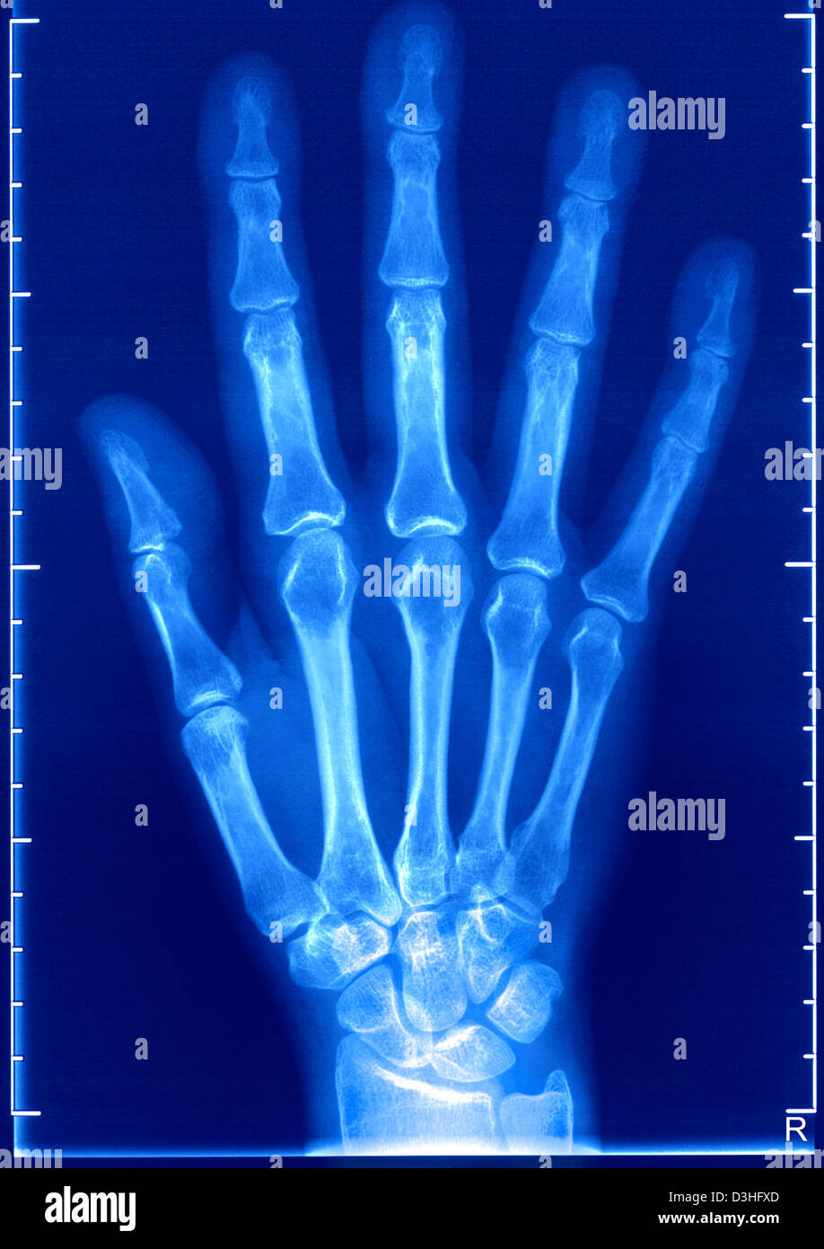 X ray normal hand hi-res stock photography and images - Alamy