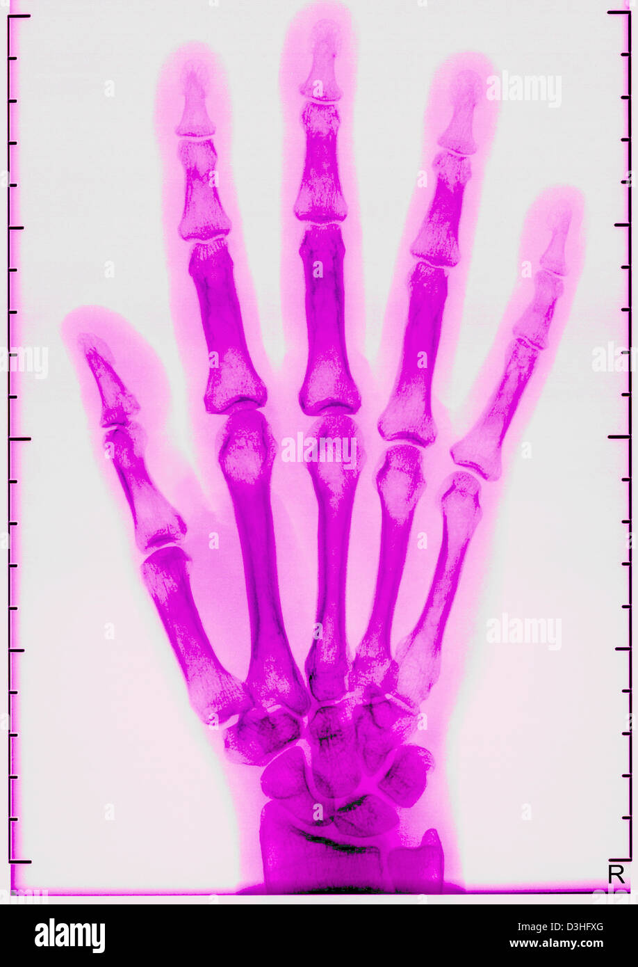 CHILD HAND, X-RAY Stock Photo - Alamy