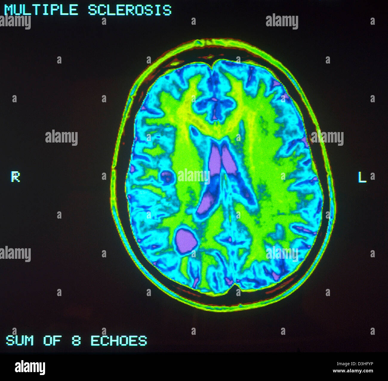 Multiple sclerosis mri hi-res stock photography and images - Alamy Multiple sclerosis mri hi-res stock photography and images - Alamy