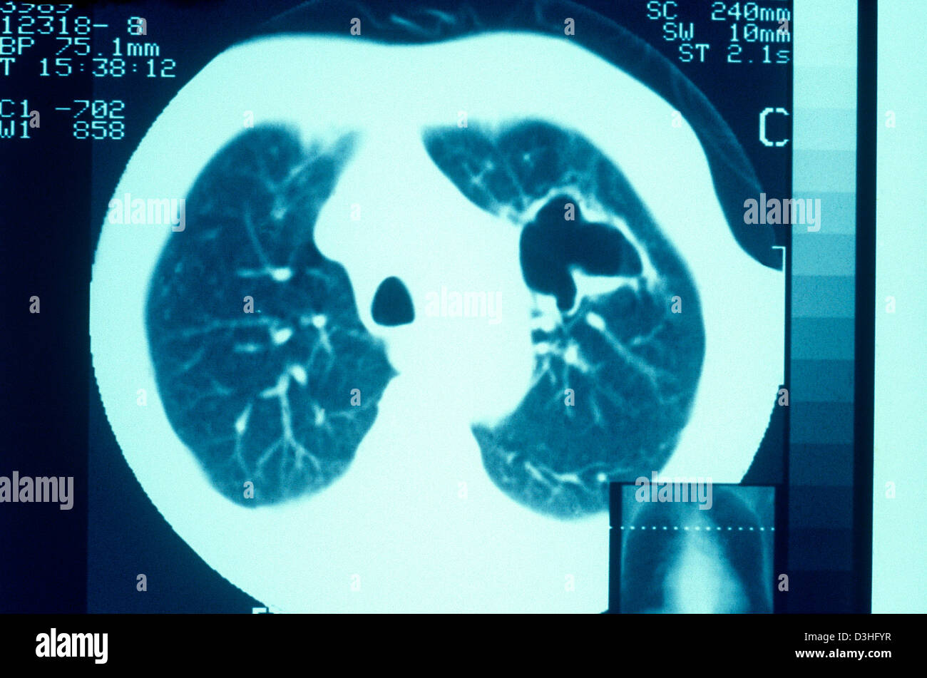HYDATID CYST, LUNG Stock Photo - Alamy