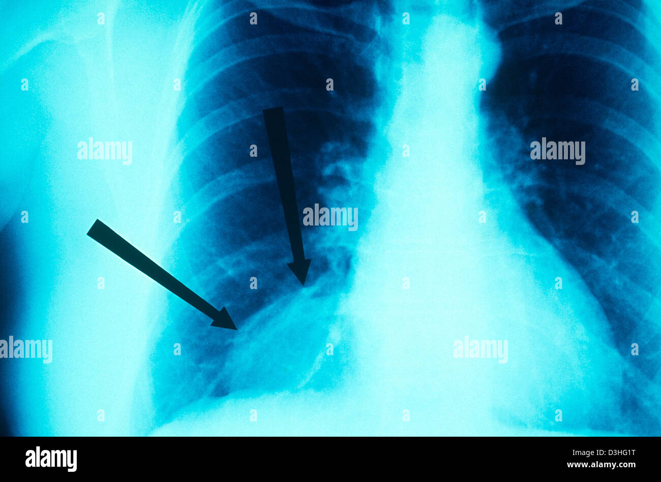 LUNG CYST, X-RAY Stock Photo - Alamy