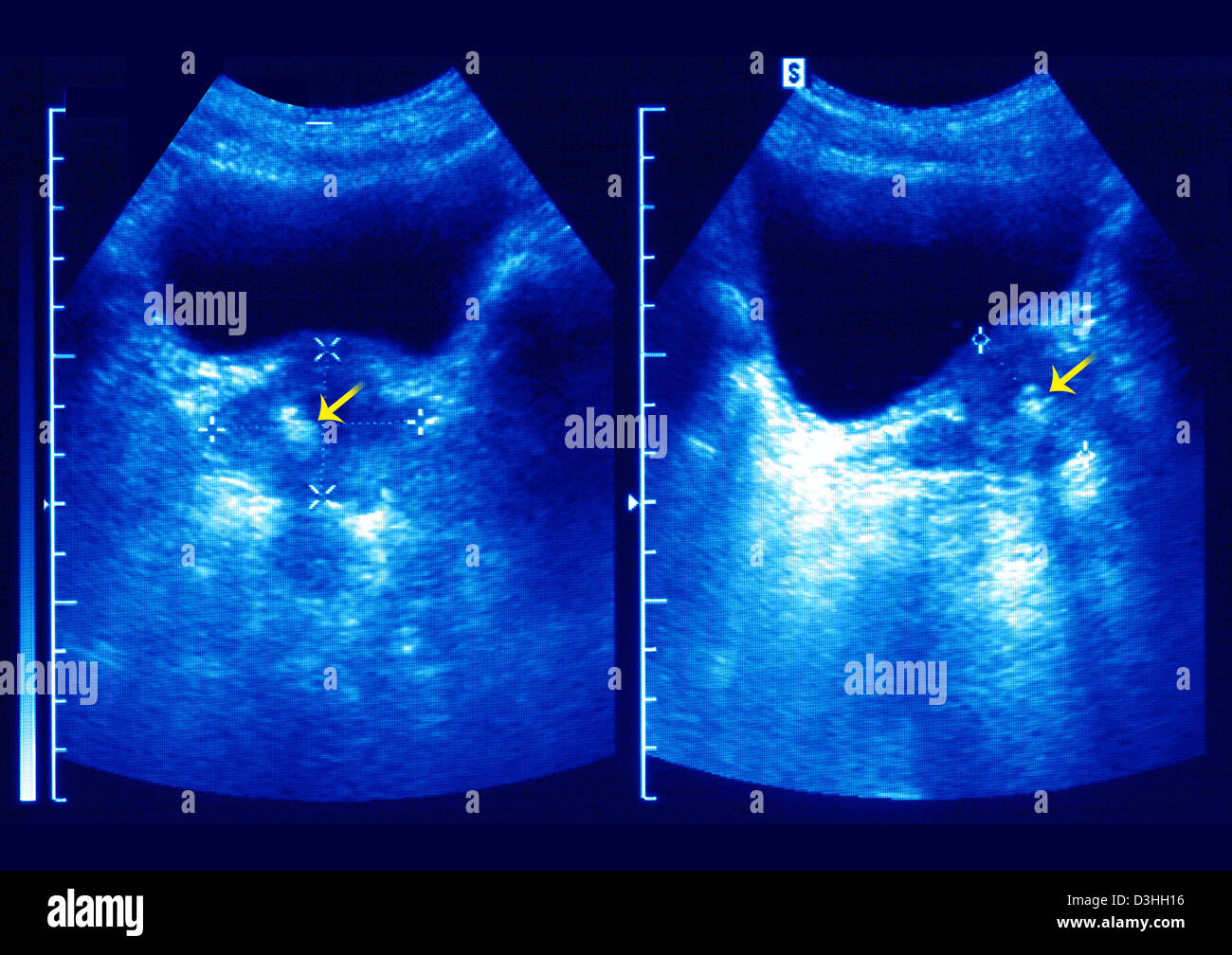 Prostate stone hi-res stock photography and images - Alamy