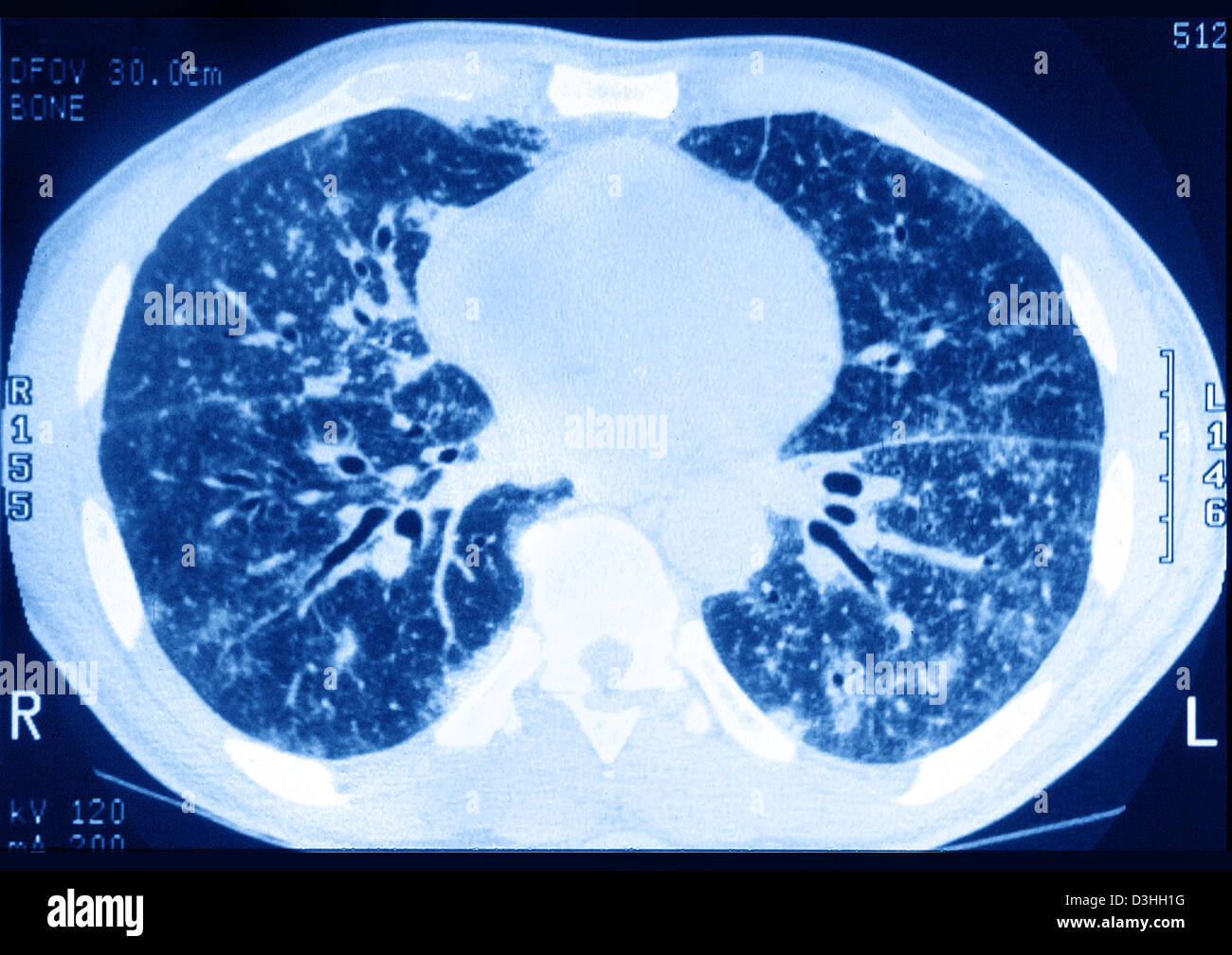 PULMONARY TUBERCULOSIS, SCAN Stock Photo - Alamy