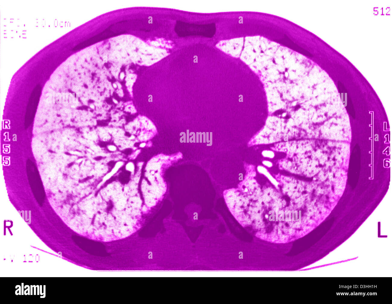 PULMONARY TUBERCULOSIS, SCAN Stock Photo - Alamy