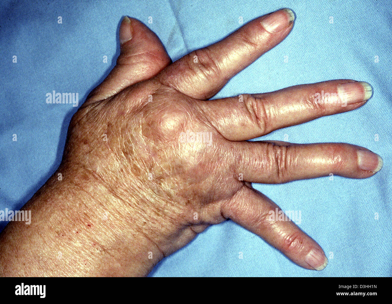 Hand deformities hi-res stock photography and images - Alamy