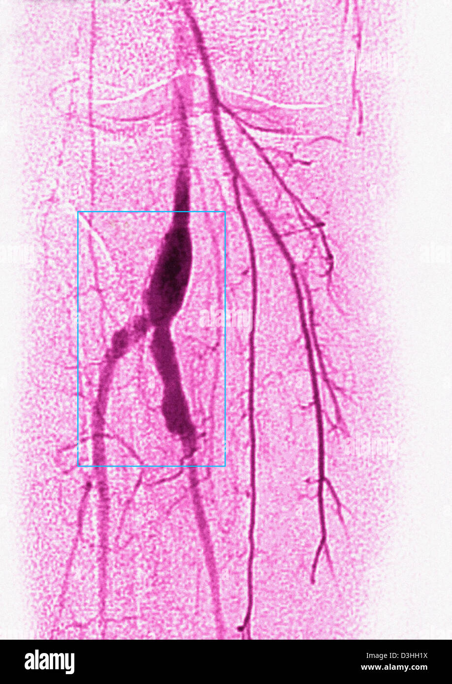 ANEURYSM OF AN ARTERY Stock Photo - Alamy