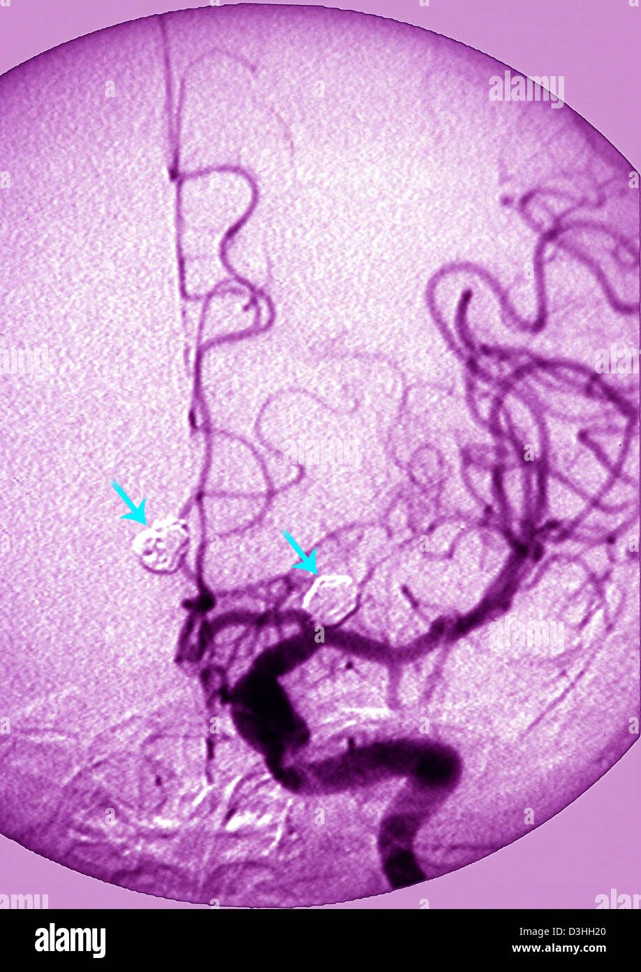 ANEURYSM OF THE BRAIN, ANGIOGR Stock Photo - Alamy