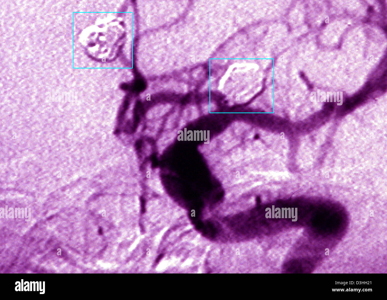 ANEURYSM OF THE BRAIN, ANGIOGR Stock Photo - Alamy