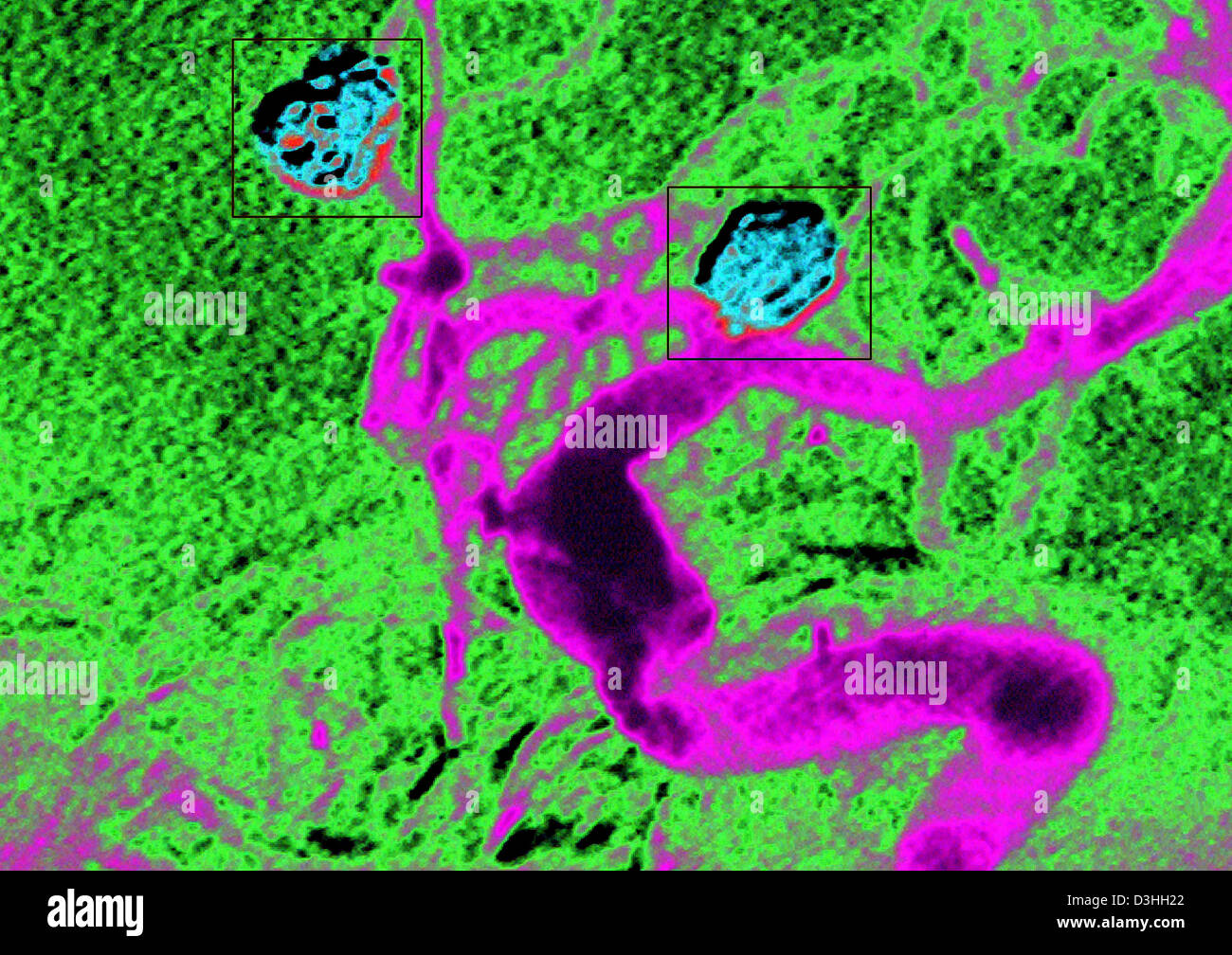 ANEURYSM OF THE BRAIN, ANGIOGR Stock Photo - Alamy