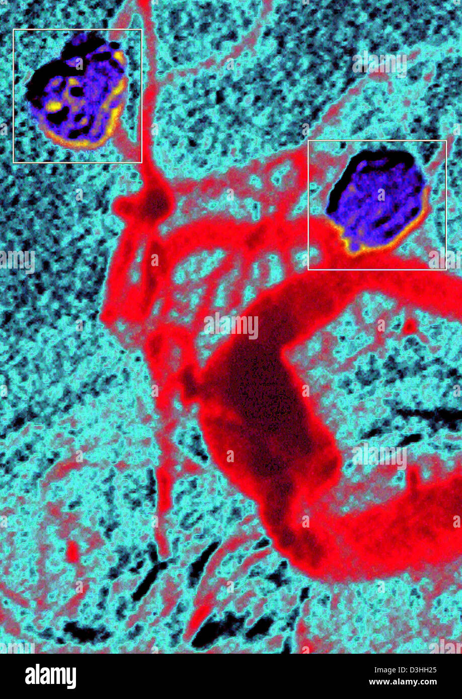 ANEURYSM OF THE BRAIN, ANGIOGR Stock Photo - Alamy