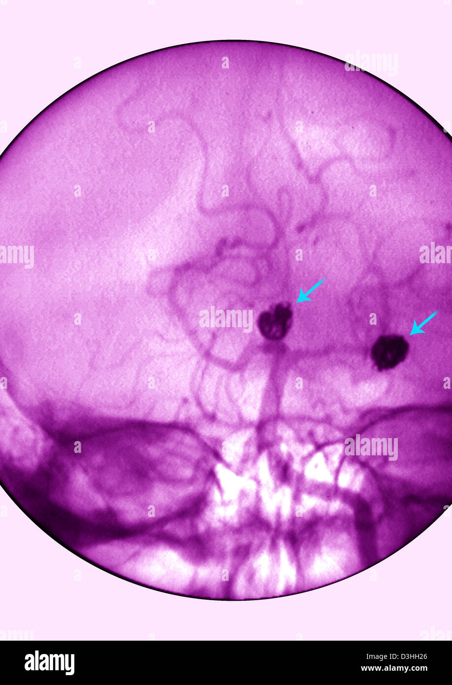 ANEURYSM OF THE BRAIN, ANGIOGR Stock Photo - Alamy