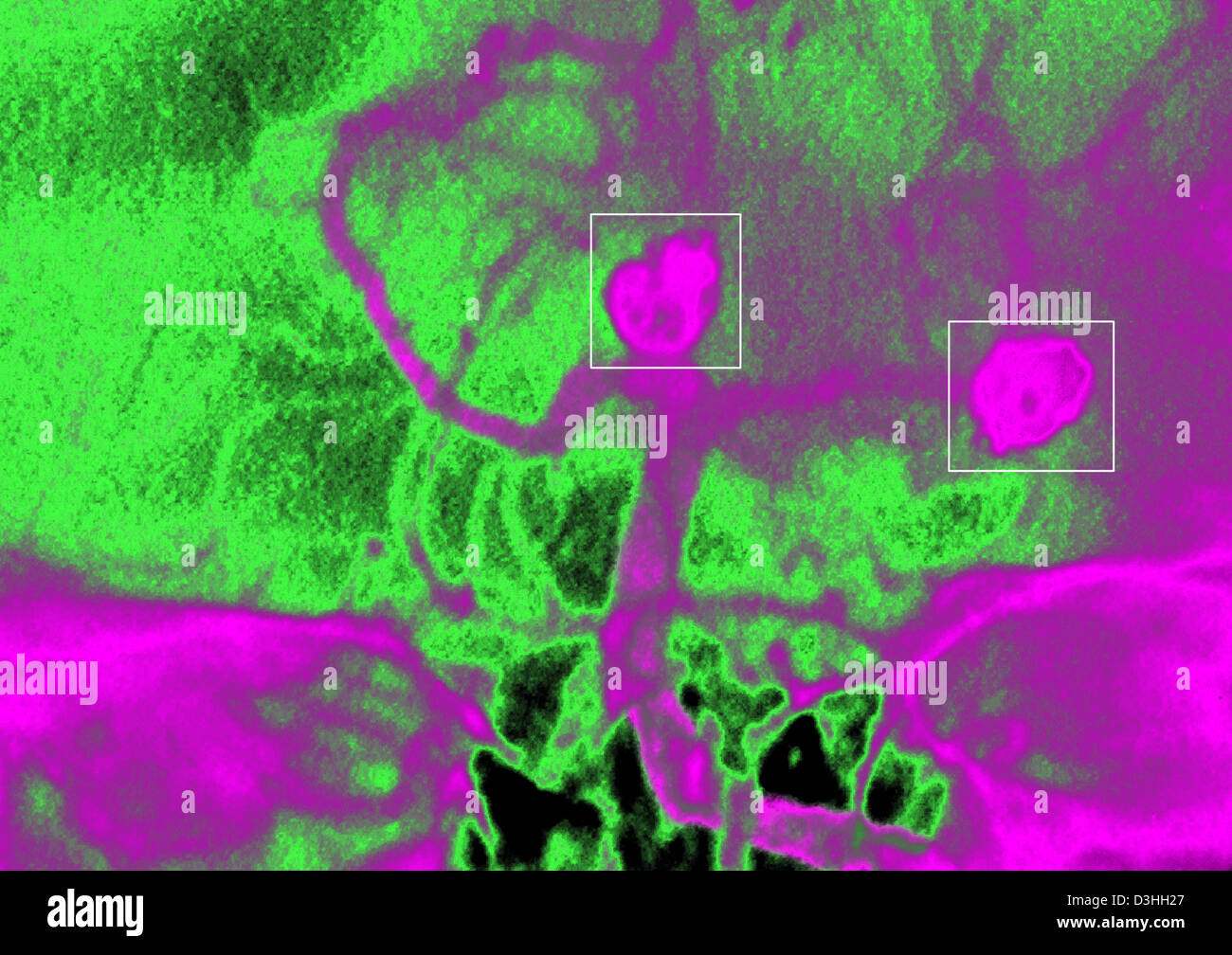 ANEURYSM OF THE BRAIN, ANGIOGR Stock Photo - Alamy