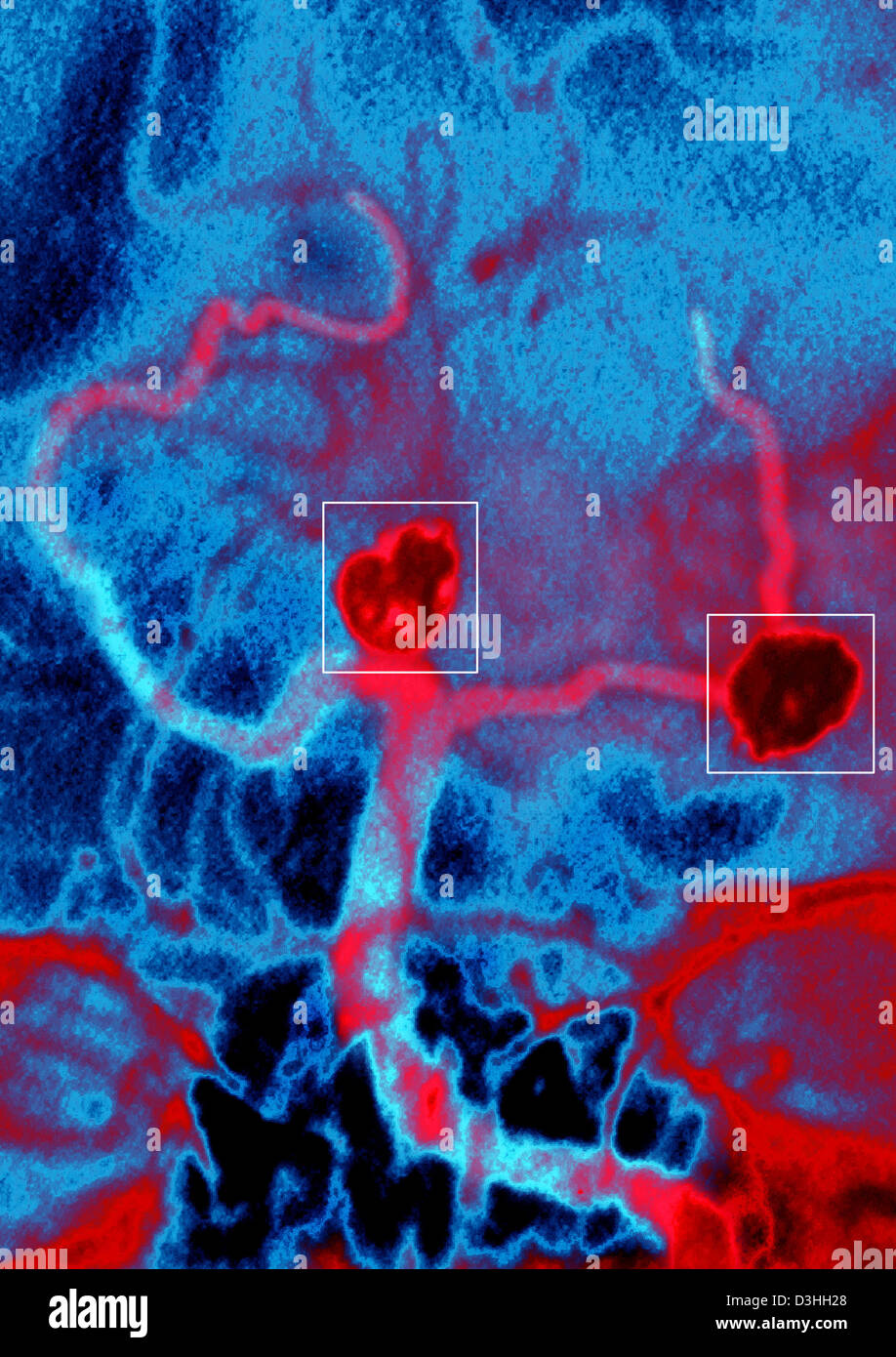 ANEURYSM OF THE BRAIN, ANGIOGR Stock Photo - Alamy