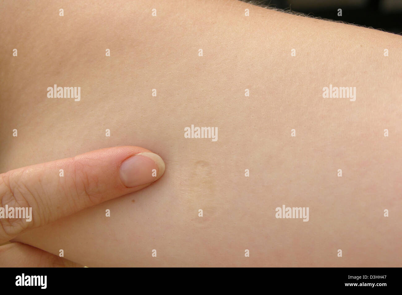 Vaccine scar hi-res stock photography and images - Alamy