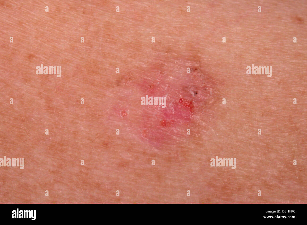 BASAL CELL CARCINOMA Stock Photo - Alamy
