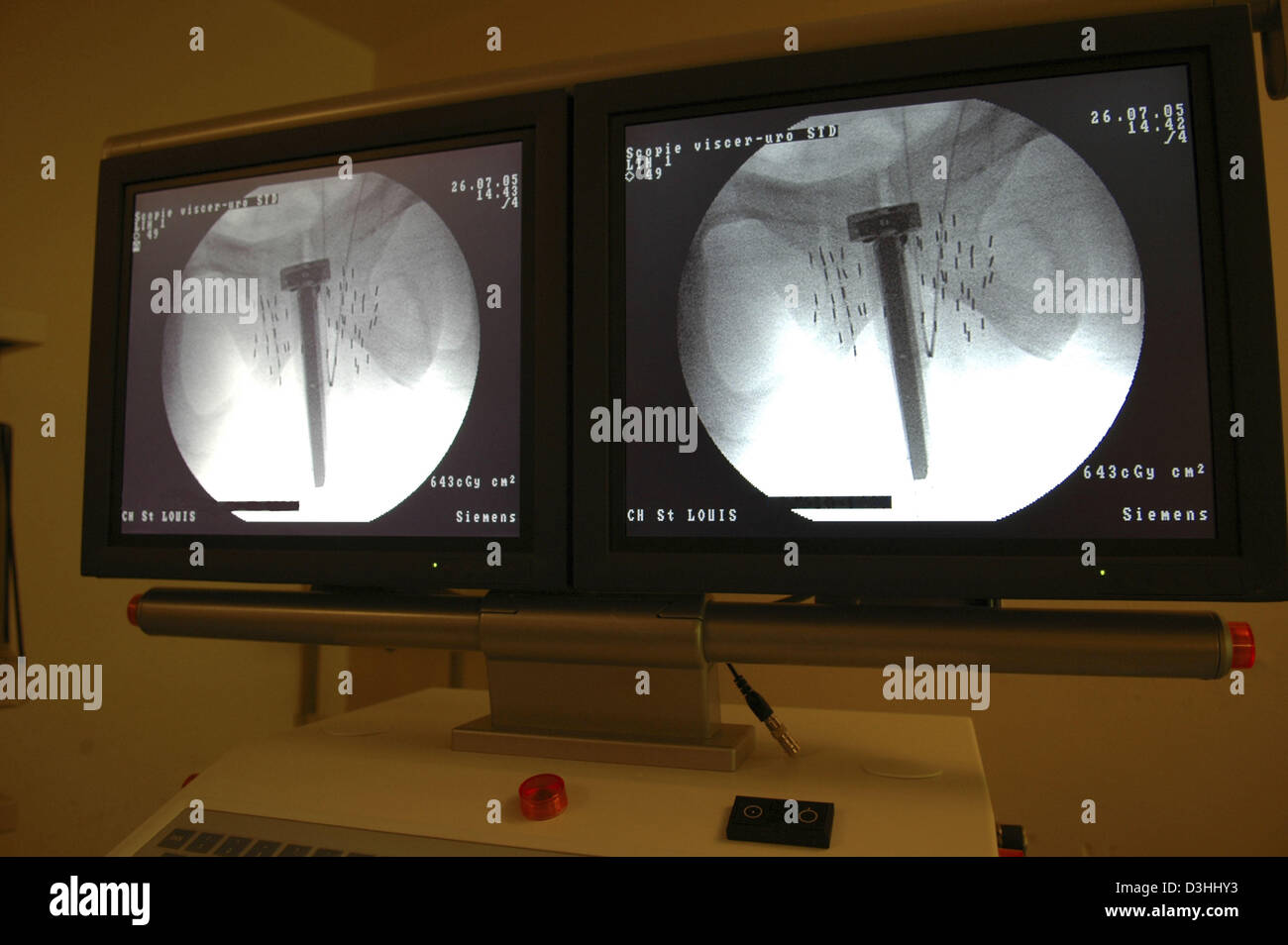 Prostate Radiotherapy High Resolution Stock Photography and Images - Alamy