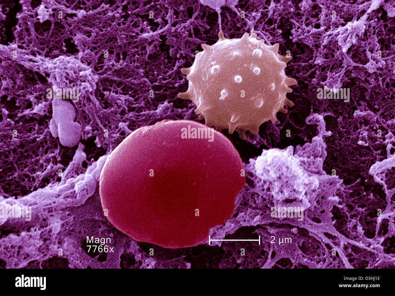 Acanthocytes hi-res stock photography and images - Alamy