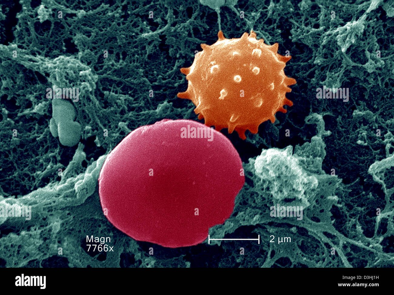 Acanthocytes hi-res stock photography and images - Alamy