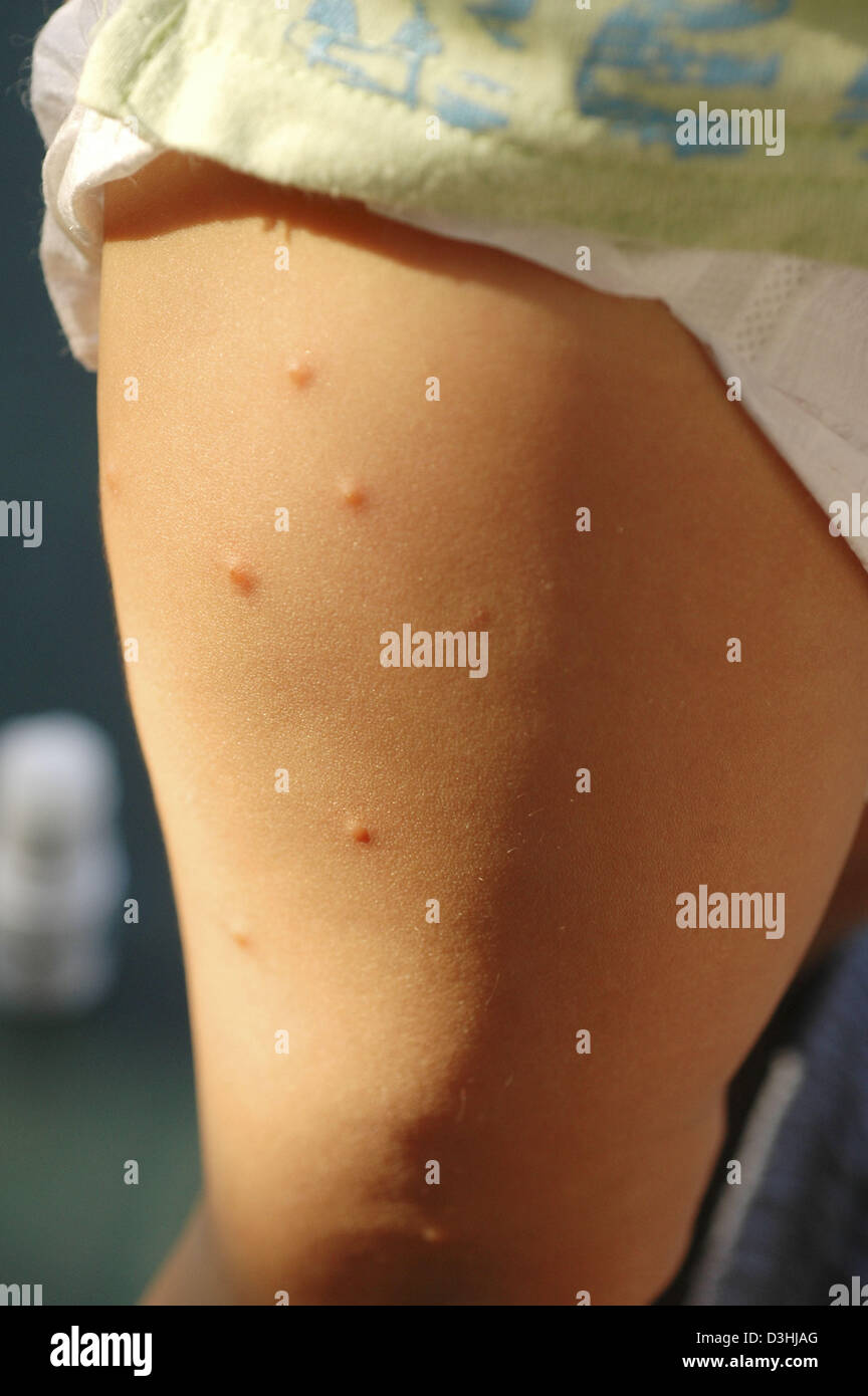 Insect bites child hi-res stock photography and images - Alamy