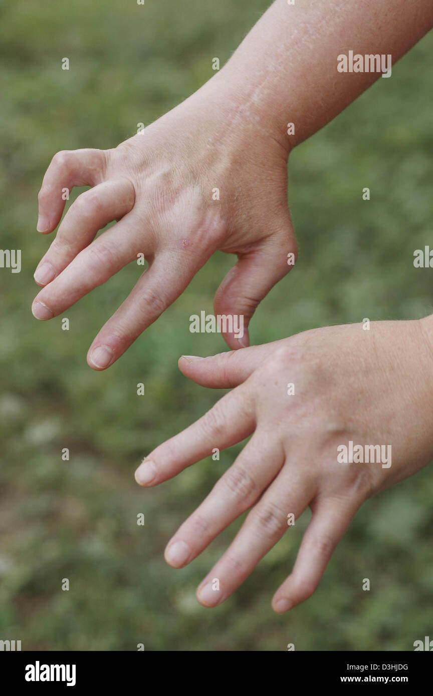 Hand deformities hi-res stock photography and images - Alamy