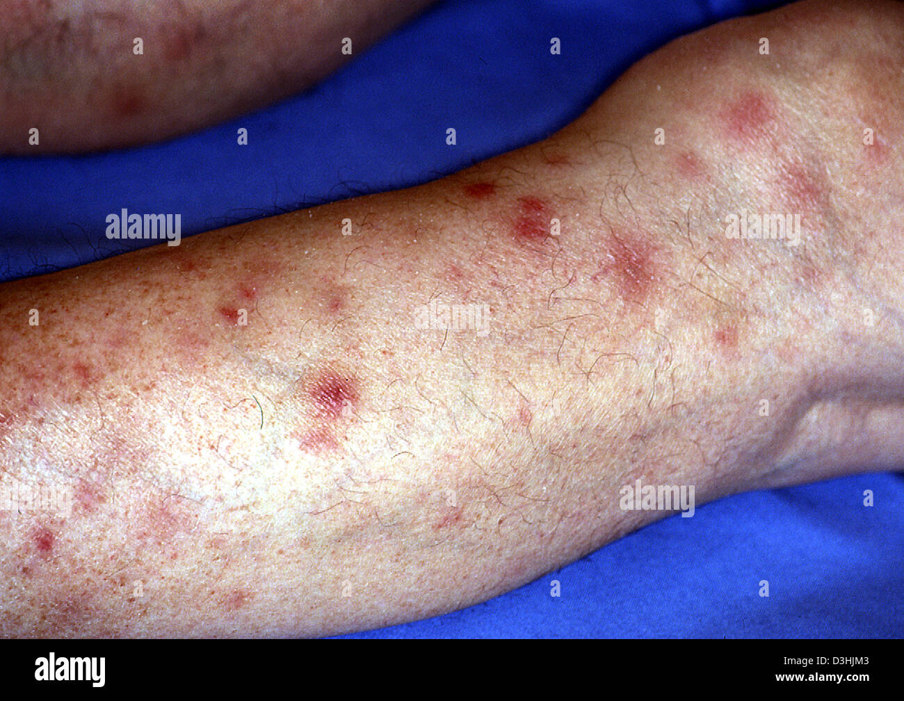 Popsicle Panniculitis