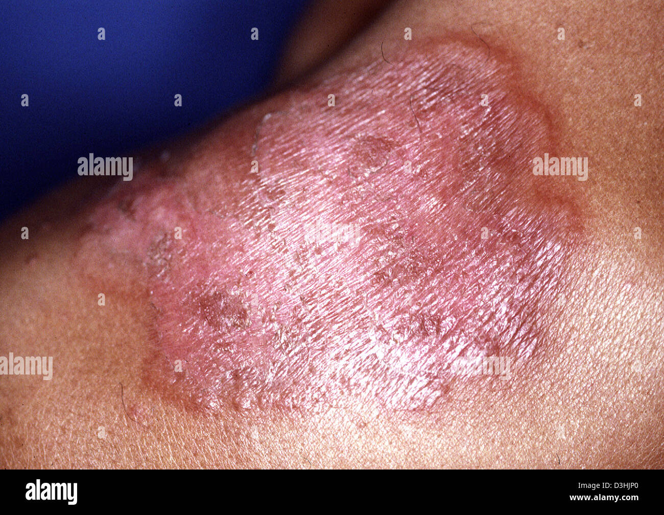 Acute febrile neutrophilic dermatosis hi-res stock photography and ...