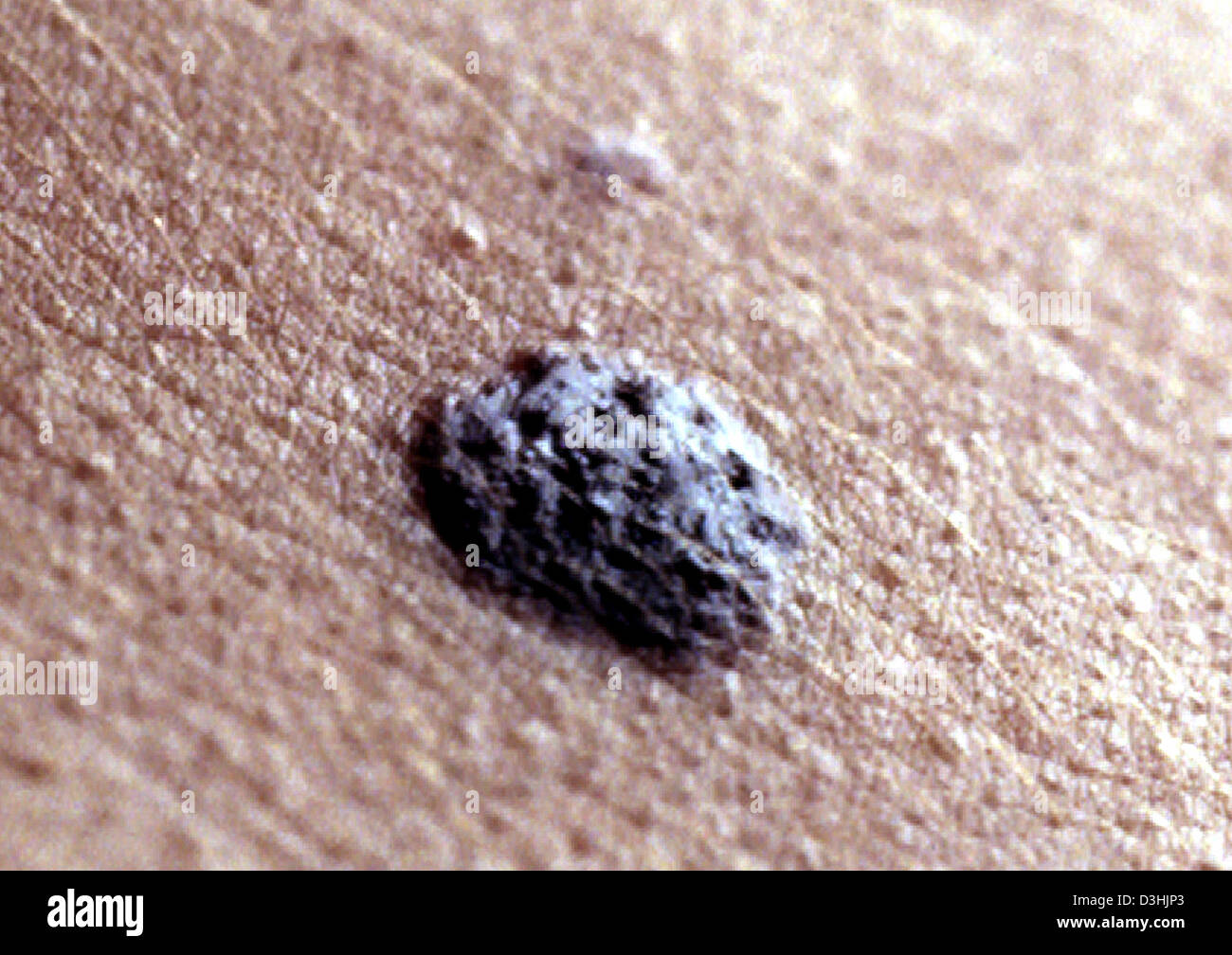 Malignant melanomas hi-res stock photography and images - Alamy