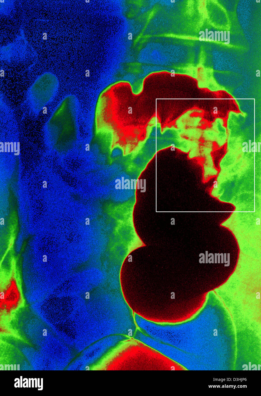 CANCER OF THE COLON, X-RAY Stock Photo - Alamy