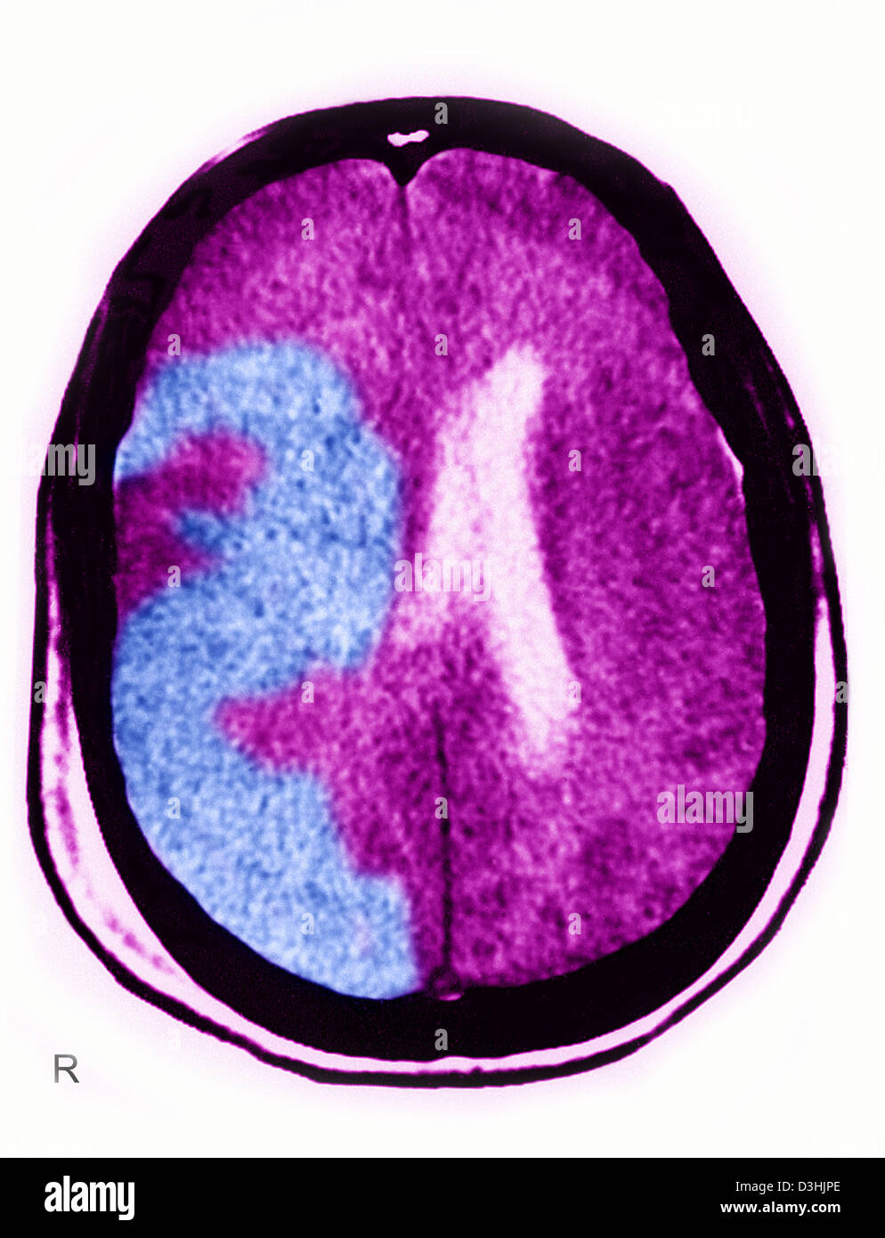 CEREBRAL EMBOLISM, SCAN Stock Photo - Alamy