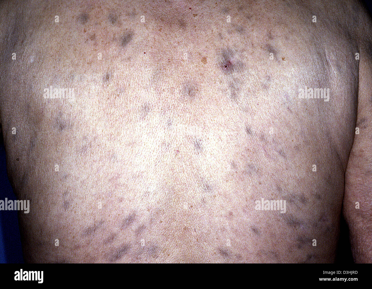 Leprosy leprosy hi-res stock photography and images - Alamy
